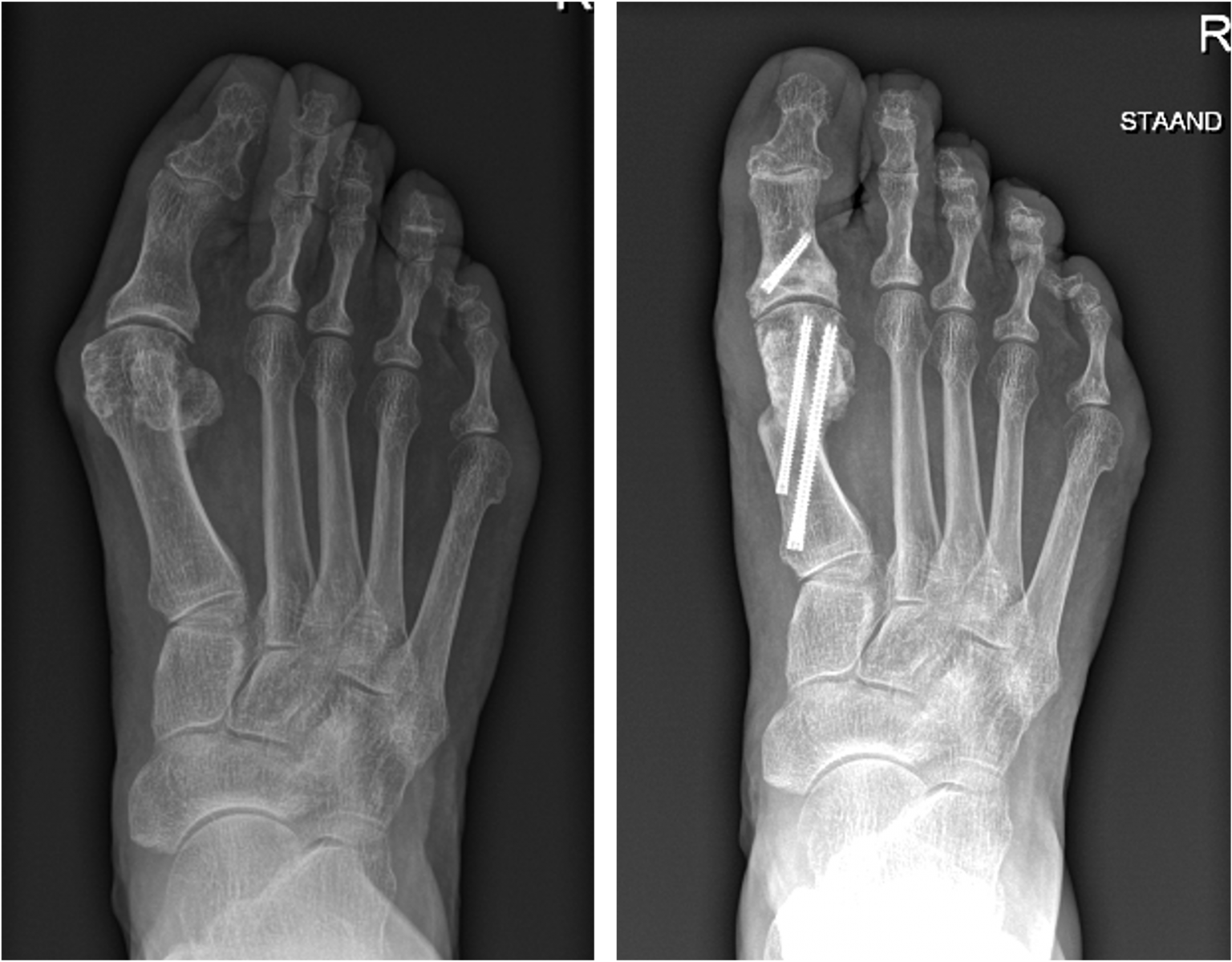 Minimally Invasive Hallux Valgus Treatment Voet En Enkel ChirurgVoet